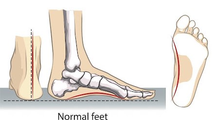 What is flat feet? | The Movement Laboratory (Physiotherapy)