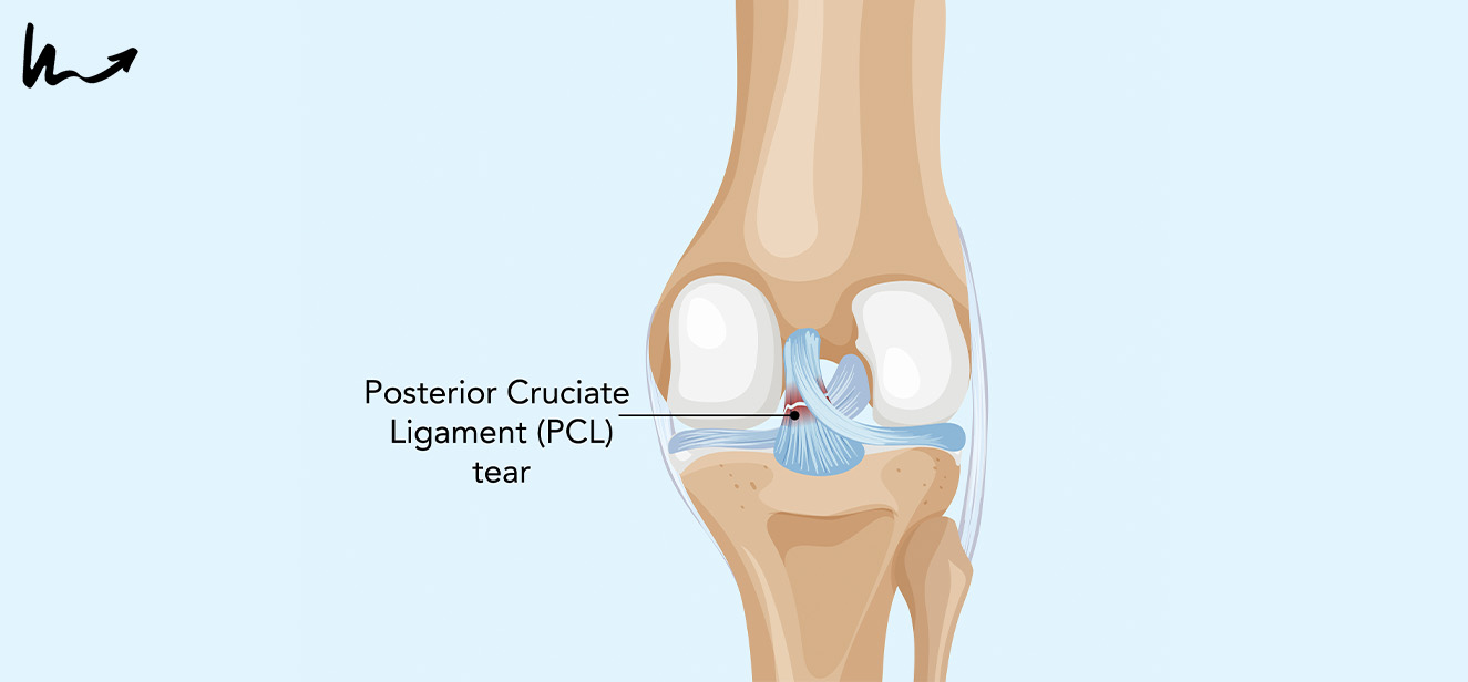Ankle Ligament Tear Healing Time | The Movement Laboratory